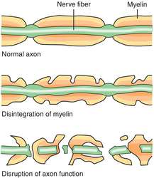 Demyelination | definition of demyelination by Medical dictionary