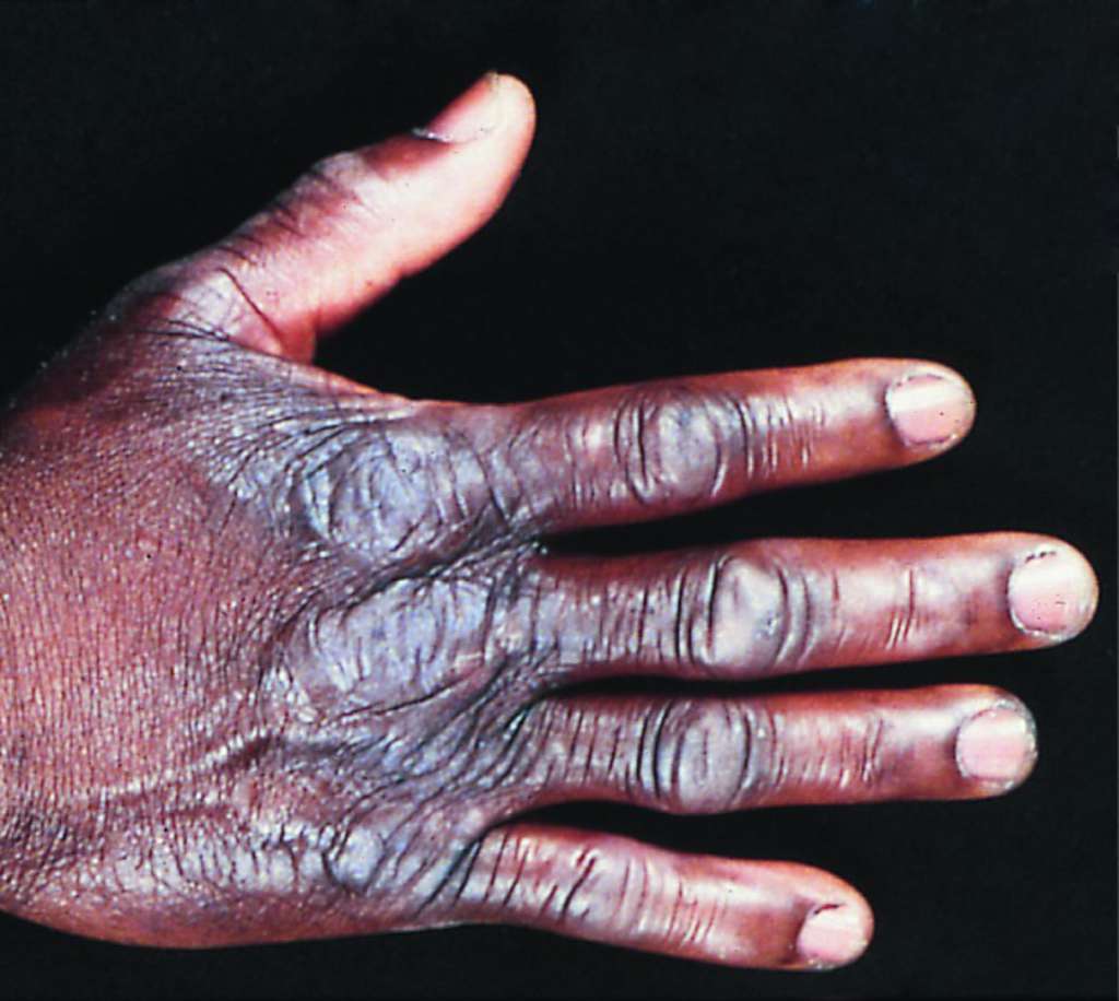 Acrokeratosis Verruciformis