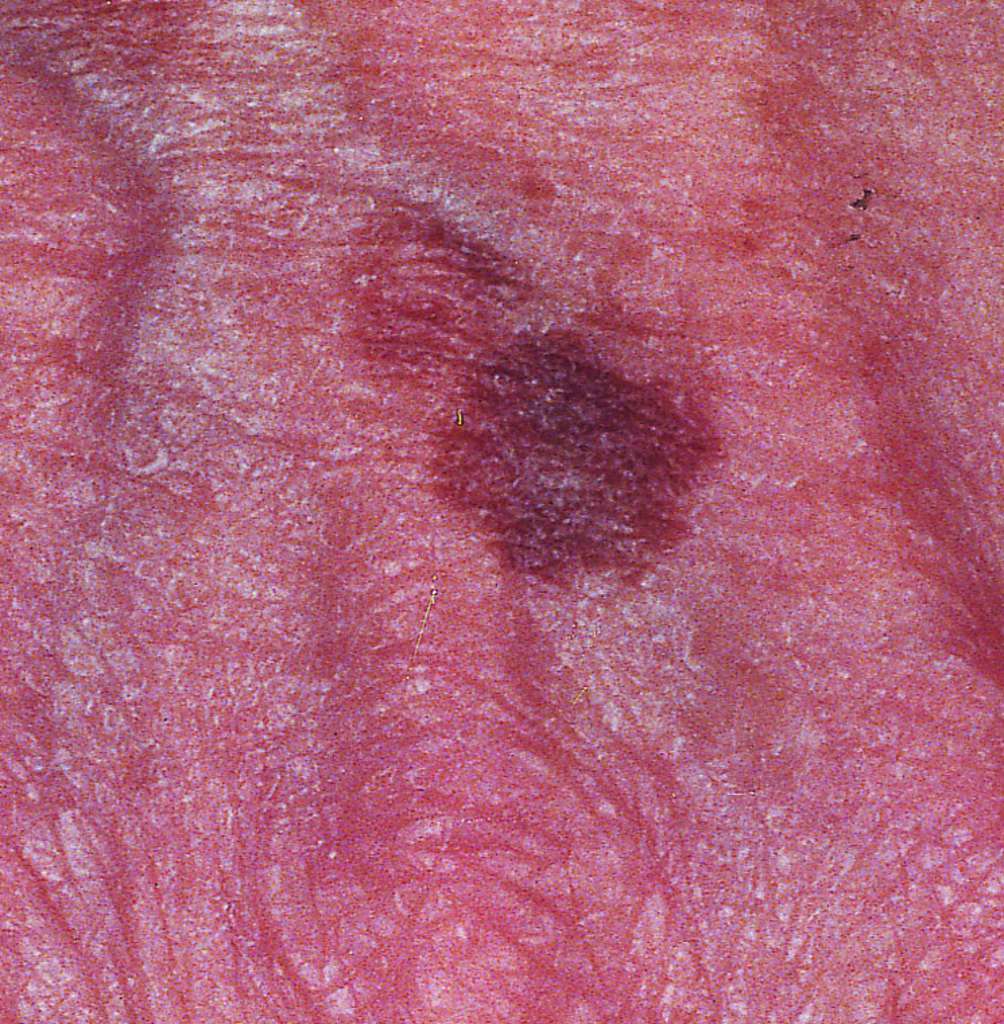 63. Melanocytic lesions – greek.doctor