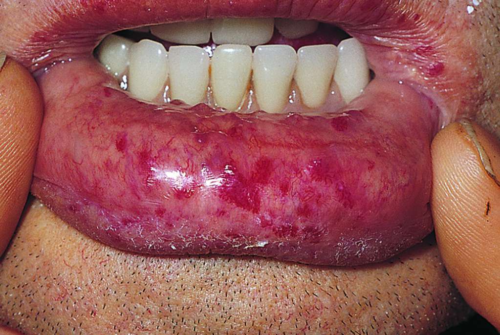 Osler Weber Rendu Syndrome The New England Journal Of Medicine A