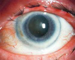 Arcus senilis | definition of arcus senilis by Medical dictionary