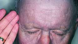 Argyria | definition of argyria by Medical dictionary