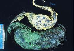 Bezoar | definition of bezoar by Medical dictionary