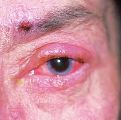 Blepharitis | definition of blepharitis by Medical dictionary