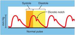 Dicrotic notch | definition of dicrotic notch by Medical dictionary