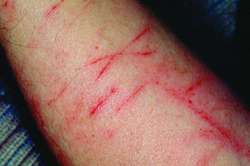 Excoriation | definition of excoriation by Medical dictionary