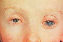 Homocystinuria | definition of homocystinuria by Medical dictionary