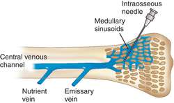 Intraosseous infusion | definition of intraosseous infusion by Medical ...