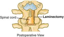 Laminectomy | definition of laminectomy by Medical dictionary