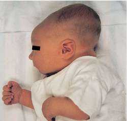 Molding | definition of molding by Medical dictionary