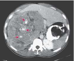 Neuroblastoma | definition of neuroblastoma by Medical dictionary