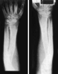 Periostitis | definition of periostitis by Medical dictionary