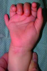 Polydactyly | definition of polydactyly by Medical dictionary