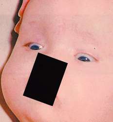 Sun-setting sign | definition of sun-setting sign by Medical dictionary