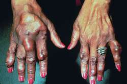 Tophus syphiliticus | definition of tophus syphiliticus by Medical ...