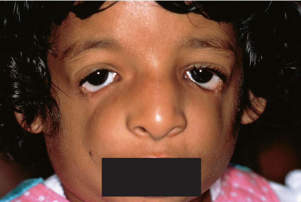 Treacher Collins Syndrome Juliana