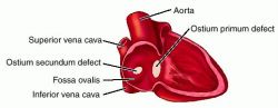Ostium Secundum