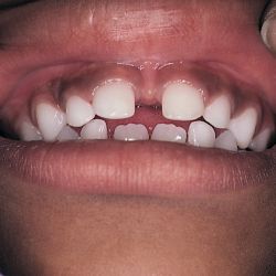 Smooth Surface Cavities : r/Dentistry