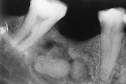 Alveolar osteitis | definition of Alveolar osteitis by Medical dictionary