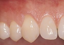 Stitch | definition of stitch by Medical dictionary